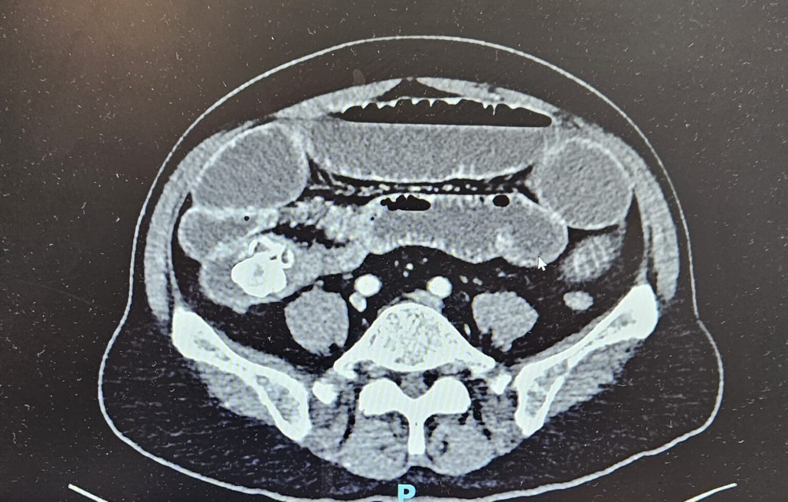 Unusual complications of gallstones – Case 2